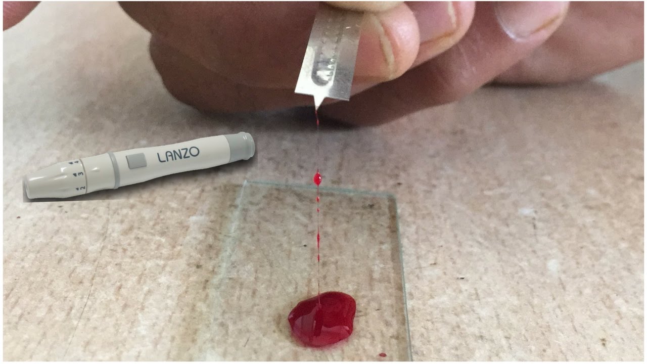 What Is There To Know About The Clotting Time Test Toptrendz What Is There To Know About The Clotting Time Test Toptrendz